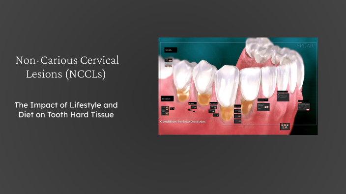 Understanding Non-Carious Cervical Lesions (NCCLs) by einas abu hjoul ...