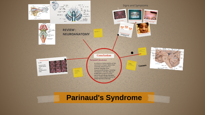 Parinaud's Syndrome by Kornkanok Saringkarisate on Prezi