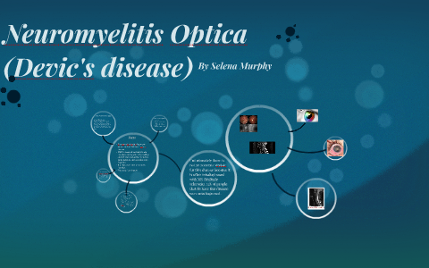 Neuromyelitis Optica (Devic's disease) by selena murphy on Prezi