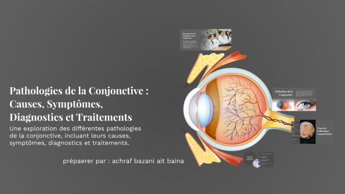 Pathologies de la Conjonctive : Causes, Symptômes, Diagnostics et ...