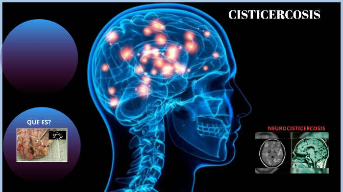 CISTICERCOSIS - NEUROCISTICERCOSIS by Leonardo Sanchez on Prezi