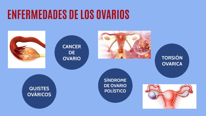 enfermedades de los ovarios by Paula Gallardo Pérez on Prezi