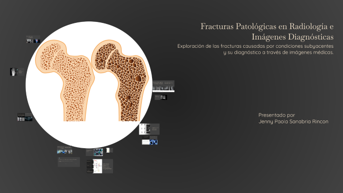 Fracturas Patológicas en Radiología e Imágenes Diagnósticas by Jenny ...