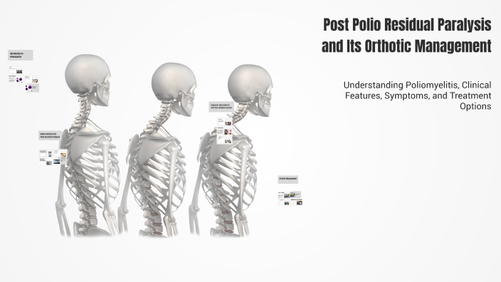 Post Polio Residual Paralysis and Its Orthotic Management by Naira KR ...