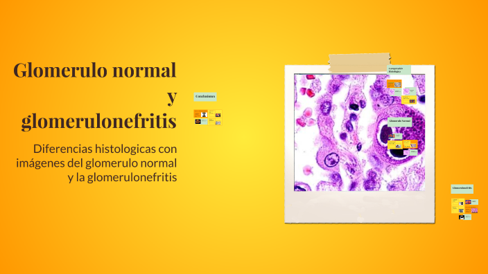 Glomerulo normal y glomerulonefritis by Michelle Quinto on Prezi
