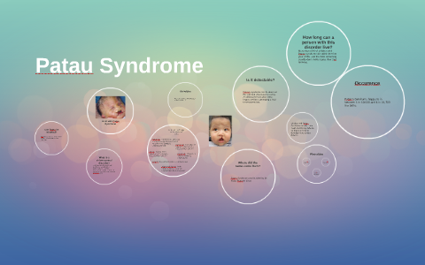 Patau Syndrome by Courtney Johnson on Prezi