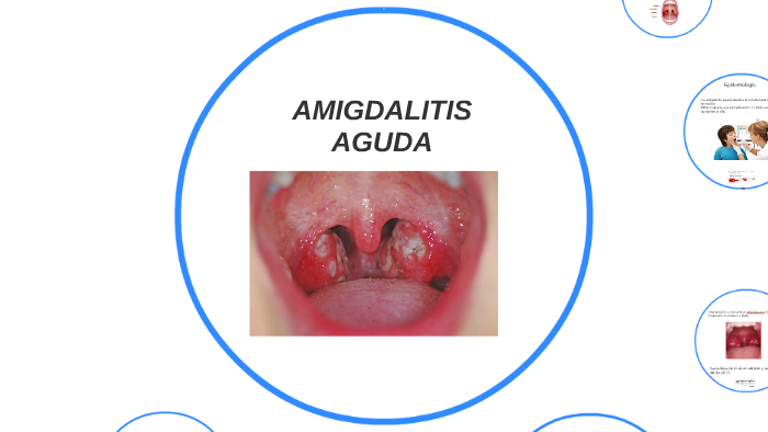 AMIGDALITIS AGUDA by on Prezi
