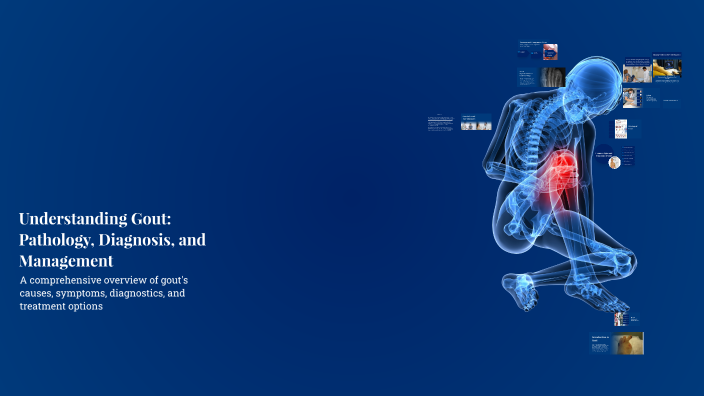 Understanding Gout: Pathology, Diagnosis, and Management by Ariel ...