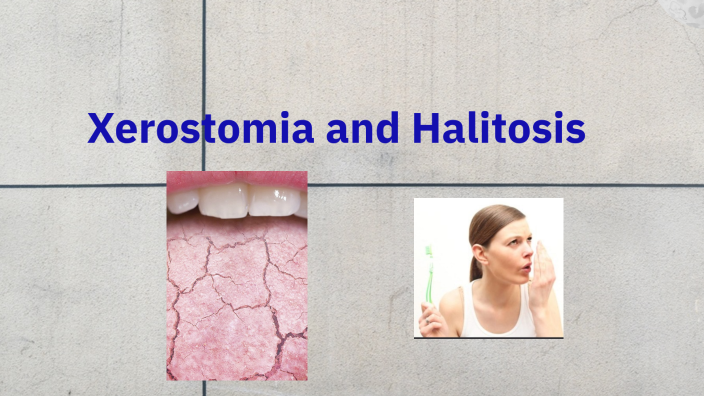 Xerostomia and Halitosis by Inas Hamdan on Prezi