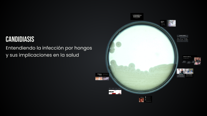 Candidiasis by Jatshiry ENCISO GAXIOLA on Prezi