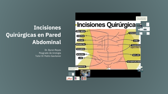 Incisiones Quirúrgicas en Pared Abdominal by Byron Reyes on Prezi