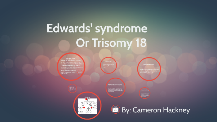 Edwards syndrome by Cameron Hackney on Prezi
