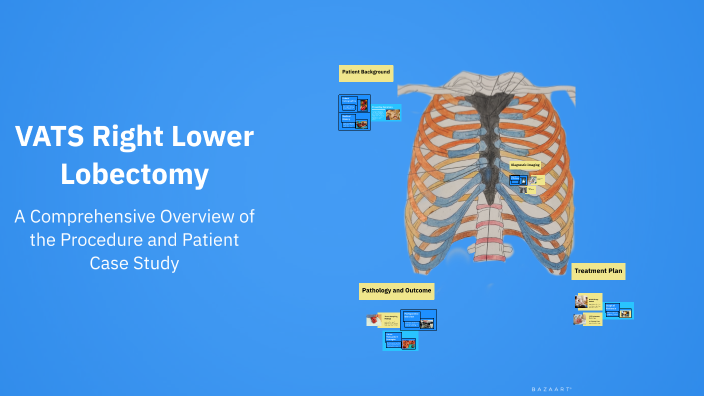 VATS Right Lower Lobectomy by Mohammad Aghebati on Prezi