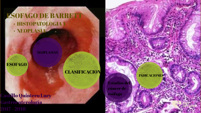 ESOFAGO DE BARRETT,Histopatología y Neoplasia by Lyu Castq on Prezi