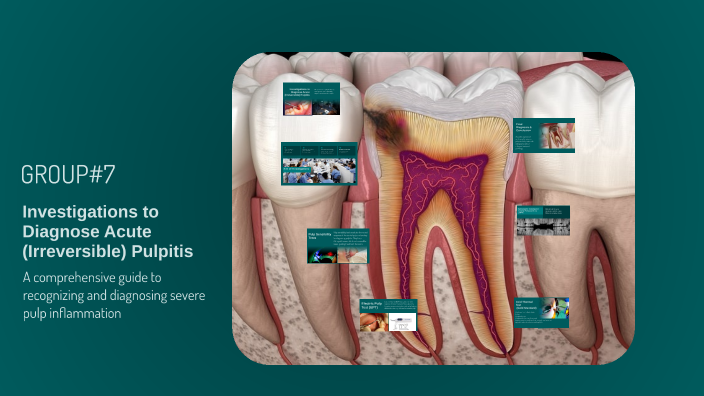 Investigations to Diagnose Acute (Irreversible) Pulpitis by Zyna Zain ...