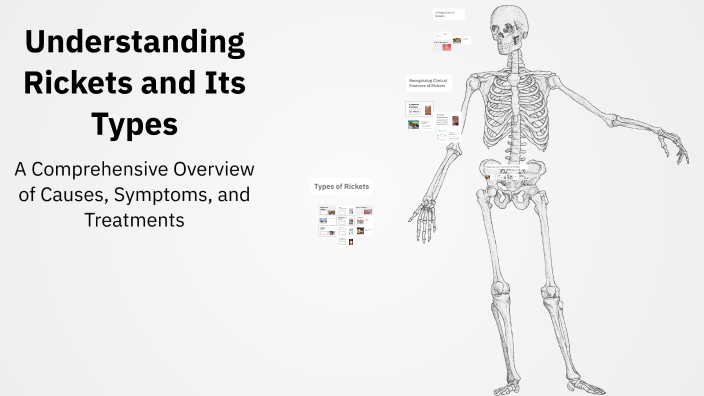 Understanding Rickets and Its Types by apdirahman awil on Prezi
