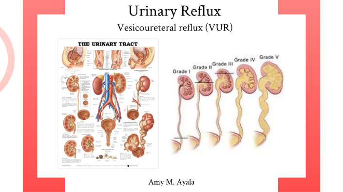 Urinary reflux by Amy Ayala on Prezi
