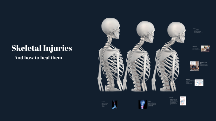 Skeletal Injuries by Stephanie Alexander on Prezi