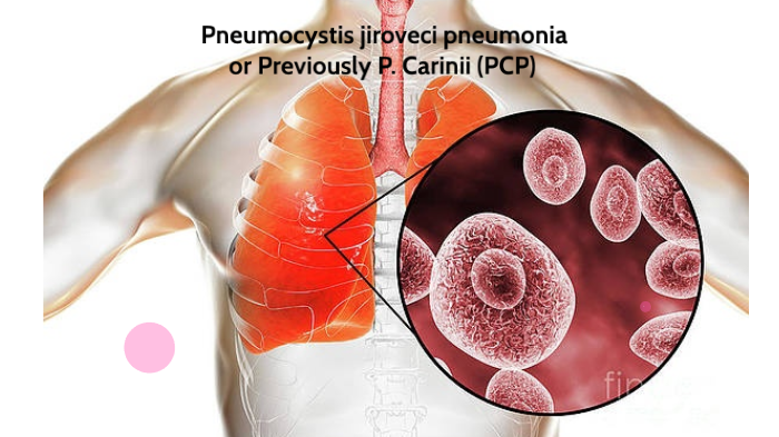 Pneumocystis jiroveci pneumonia (PCP) by Momen Natsheh on Prezi