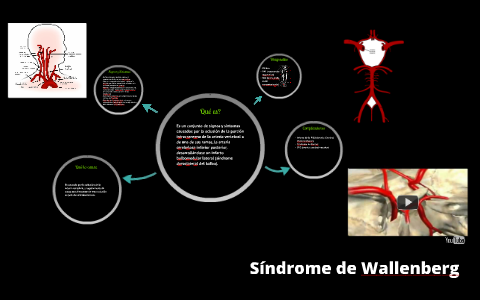 Sindrome de Wallenberg by Xavier Pérez on Prezi