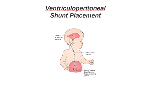 Ventriculoperitoneal Shunt Placement by Ty Galloway on Prezi
