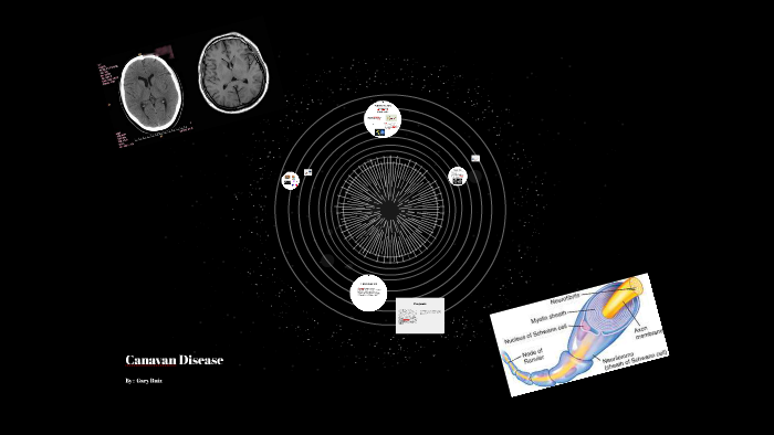 Canavan by Gary Alexander on Prezi