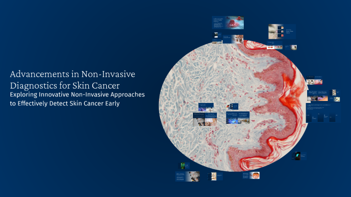 Advancements in Non-Invasive Diagnostics for Skin Cancer by oggy vavi ...