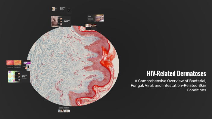 HIV-Related Dermatoses by Okech Michael on Prezi
