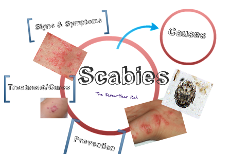 Scabies by Dana Woodruff on Prezi