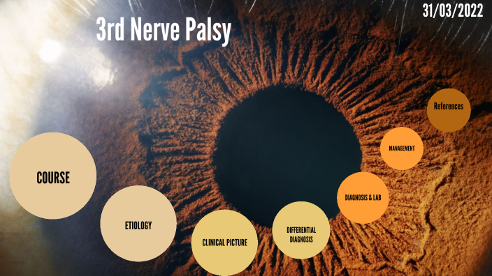 3rd nerve palsy by Rozan Moustafa on Prezi