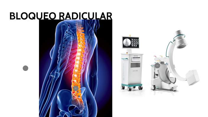 BLOQUEO RADICULAR by Francisco Cedillo on Prezi