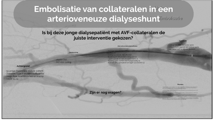 Embolisatie van collateralen in een arterioveneuze dialyseshunt by ...