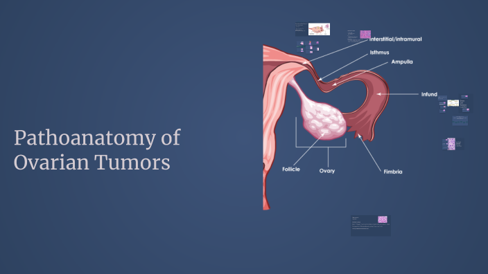 Pathoanatomy of Ovarian Tumors by Ellen Sarkissian on Prezi