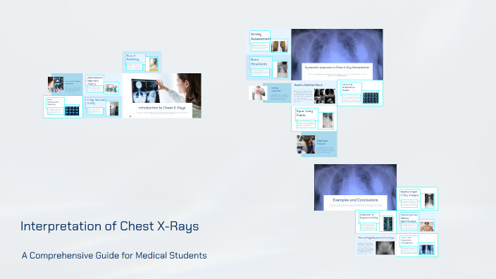 Interpretation of Chest X-Rays by Moksha Shah on Prezi