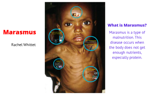 Marasmus- Food Tec by Rachel Whittet on Prezi