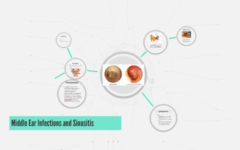 Middle Ear Infections and Sinusitis by Ariana Reichert on Prezi