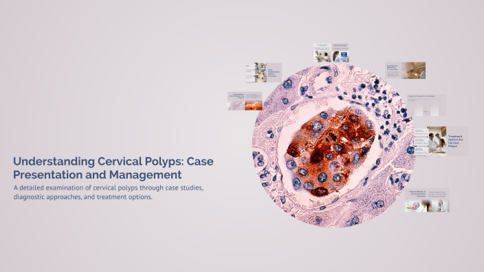 Understanding Cervical Polyps: Case Presentation and Management by ...