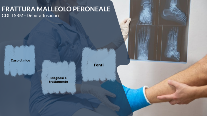FRATTURA MALLEOLO PERONEALE by Debora Tosadori on Prezi