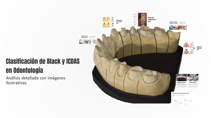 Clasificación de Black y ICDAS en Odontología by Emilio Munguía Marañón ...