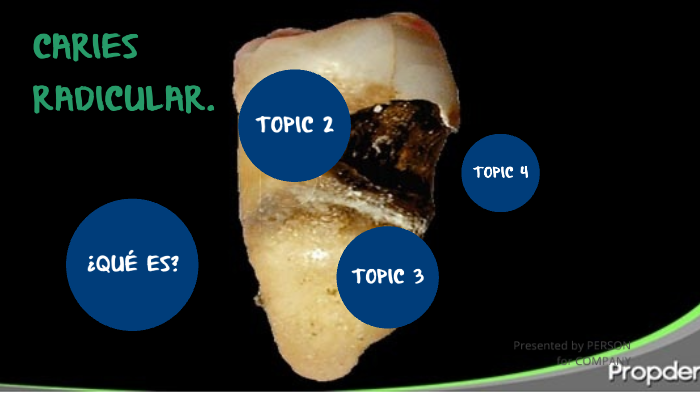 CARIES RADICULAR by Mariana Barba