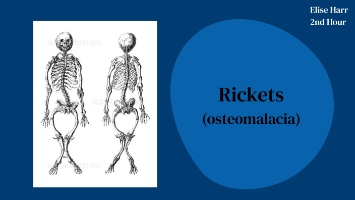 Rickets by Elise Harr on Prezi