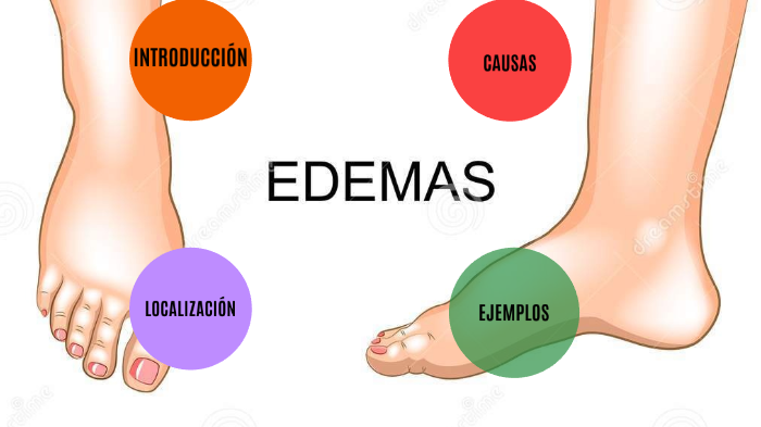 Edema by Agustin Anoria Muñoz on Prezi