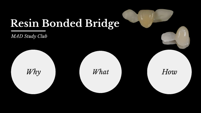 Resin Bonded Bridge by Guy Happy on Prezi