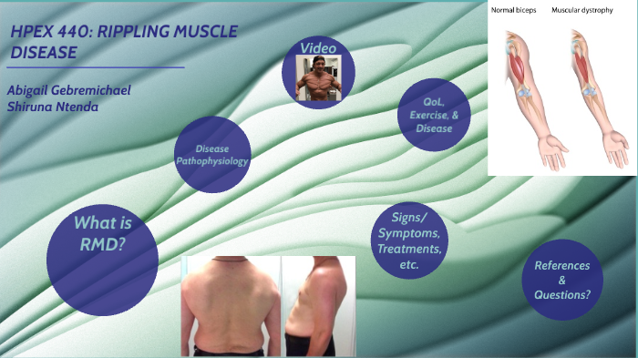 Rippling Muscle Disease (RMD) by abby gebremichael on Prezi