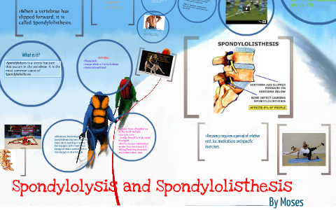 spondylolysis and Spondylolisthesis by moses sundufu