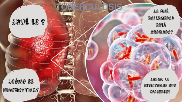TUBERCULOSIS by Alumnas Anatomía on Prezi