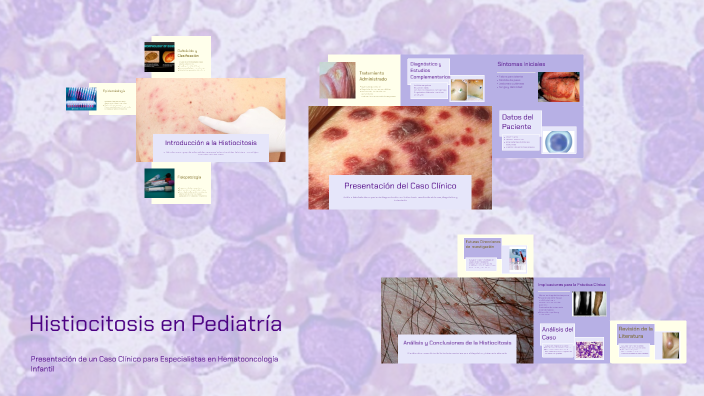 Histiocitosis en Pediatría by elena sossi on Prezi
