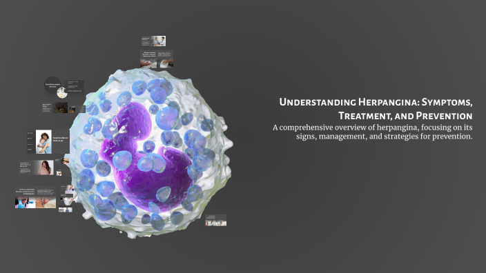 Understanding Herpangina: Symptoms, Treatment, and Prevention by shahd ...