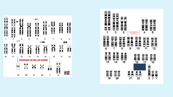 SÍNDROME DE MILLER DIEKER by Juliana Tosta on Prezi