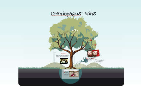 Craniopagus Twins by on Prezi